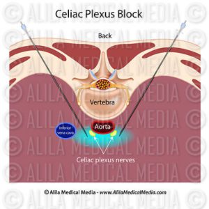 Prestige Pain Centers - Celiac Plexus Nerve Block